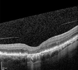 Age-Related Macular Degeneration – Timothy Jackson