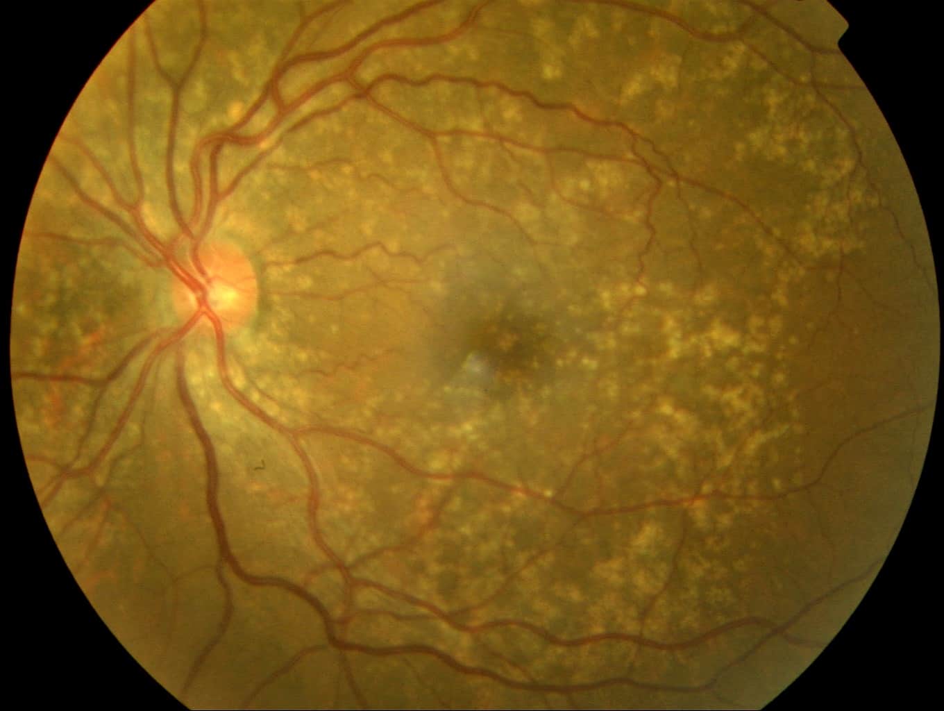 Age-Related Macular Degeneration – Timothy Jackson