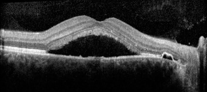 Central Serous Chorioretinopathy Cscr Timothy Jackson