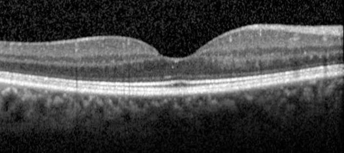 Age-Related Macular Degeneration – Timothy Jackson