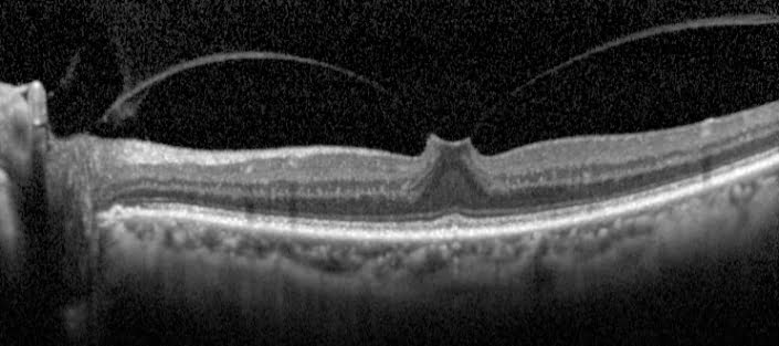 Vitreomacular traction (VMT) – Timothy Jackson