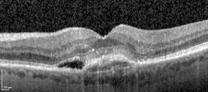 Age-Related Macular Degeneration – Timothy Jackson