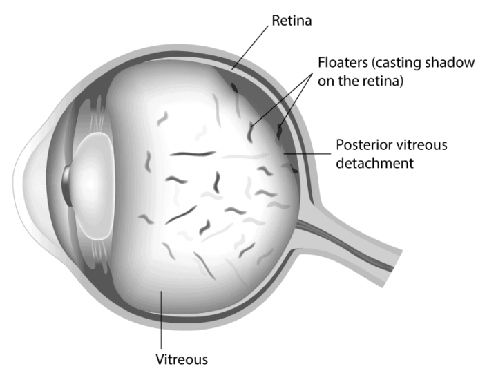 PVD and Floaters – Timothy Jackson