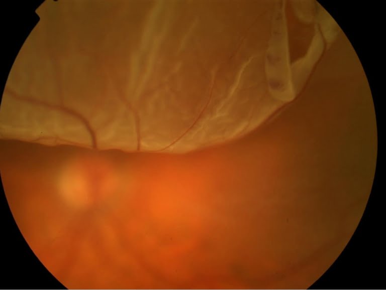 Retinal Detachment – Timothy Jackson
