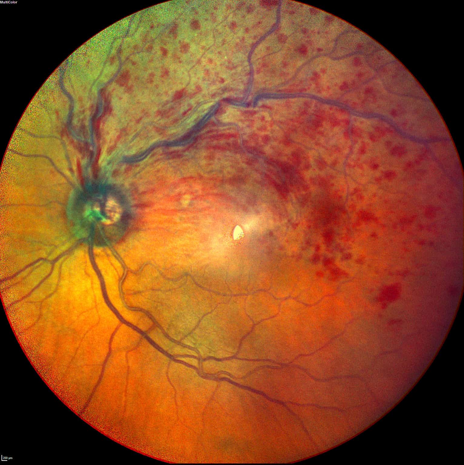 Retinal Vein Occlusion – Timothy Jackson