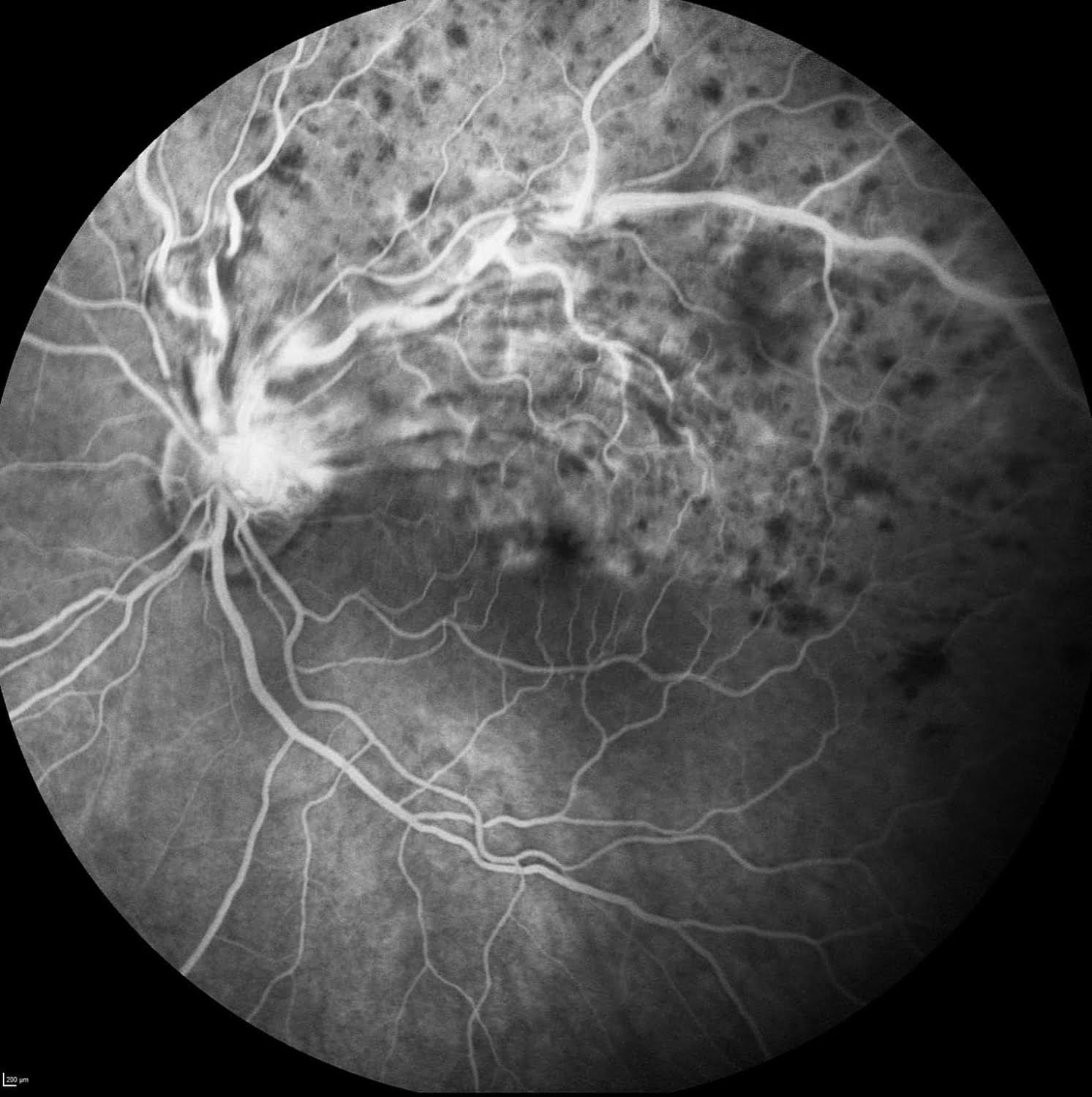 Retinal Vein Occlusion – Timothy Jackson
